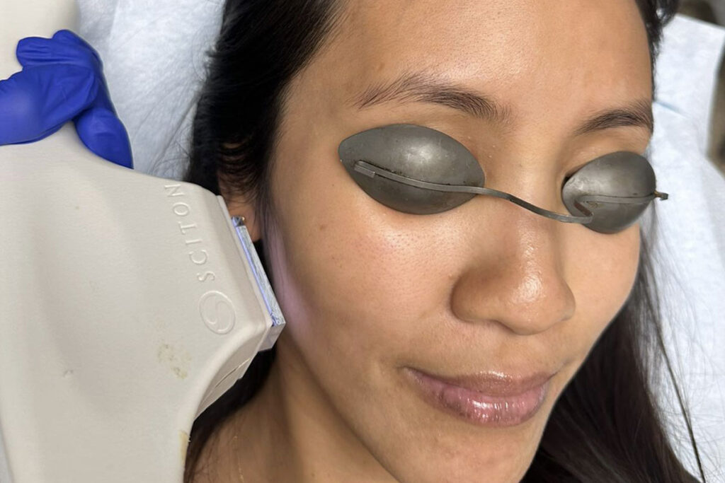 BBL Laser in San Diego, CA | South Coast MedSpa