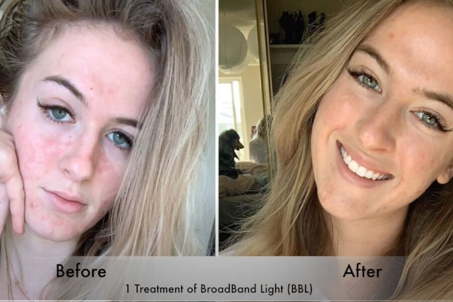 BBL - BroadBand Light Treatment | South Coast MedSpa