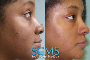 Acne Scar Removal - South Coast Med Spa