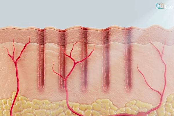 UltraClear Laser-Coring™ | South Coast Med Spa